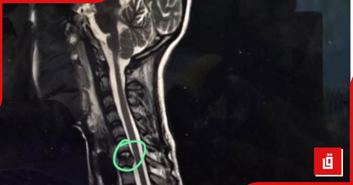 Yumnu Undergoes Critical Surgery